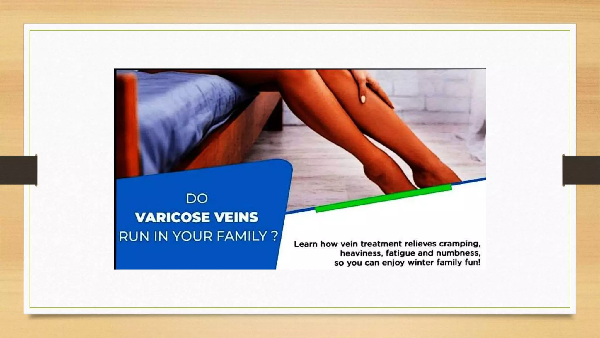 VARICOSE VEINS | PPT | Free Download