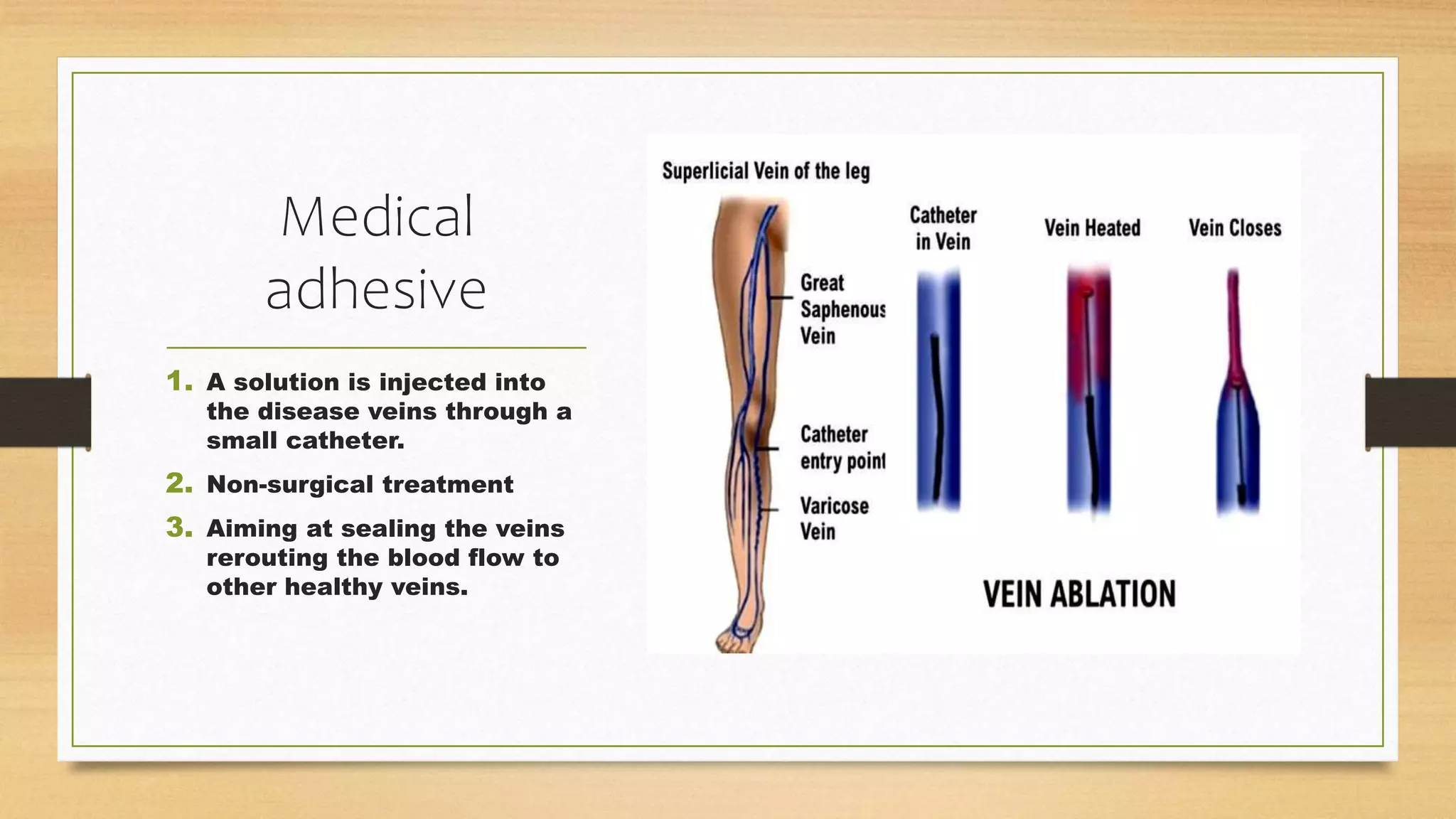 VARICOSE VEINS | PPT | Free Download