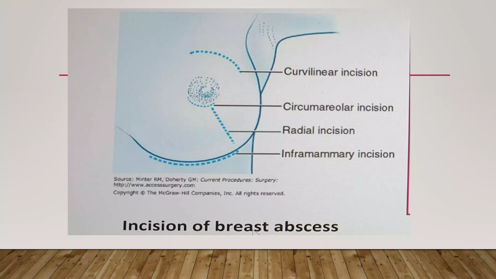 Surgical anatomy of the breast.pptx