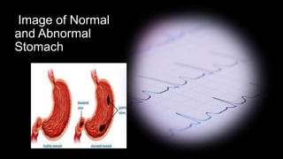 Presentation.pptx peptic ulcers disease | PPTX