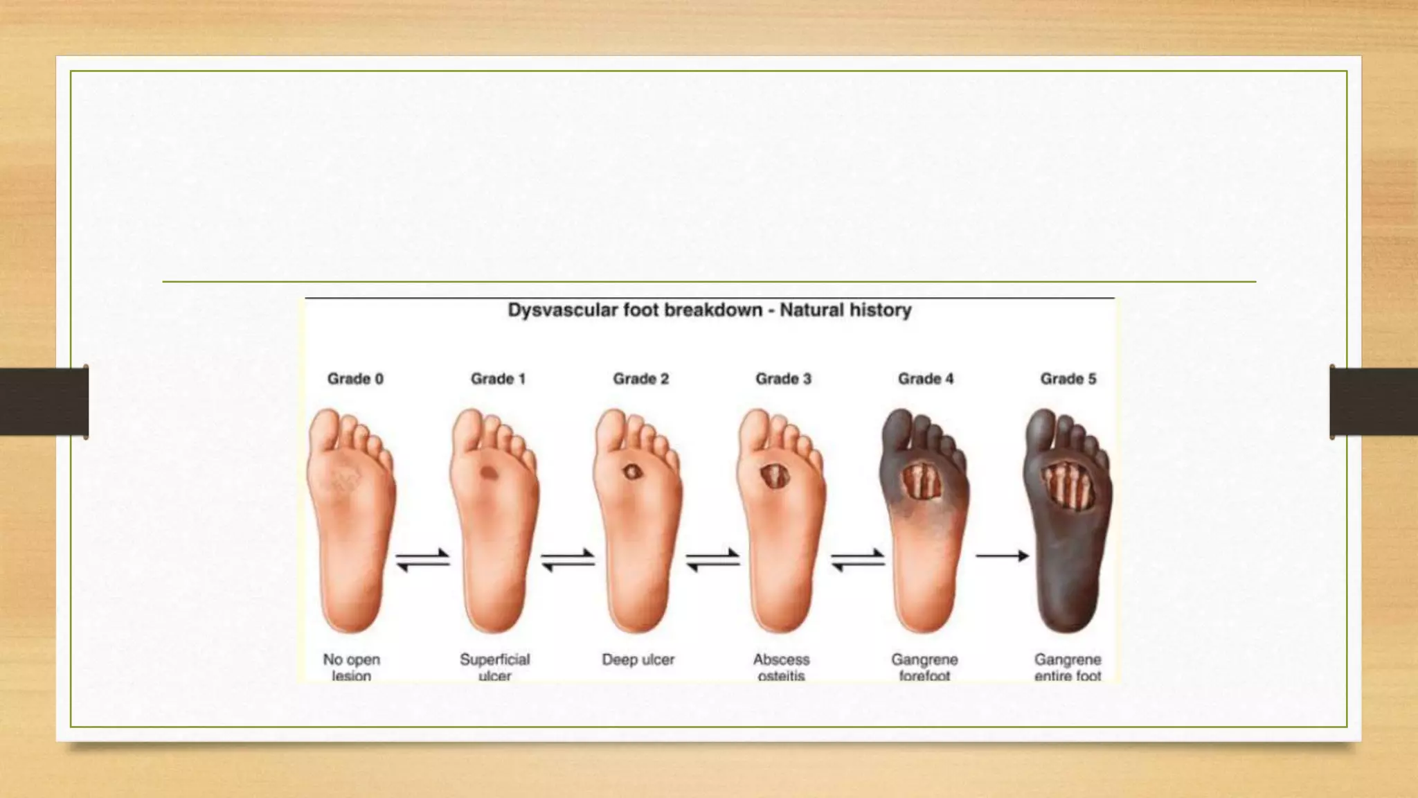 Diabetic foot | PPTX