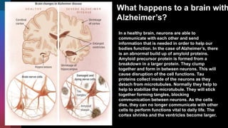 Alzheimer's Final Project by Adriana Torres | PPTX
