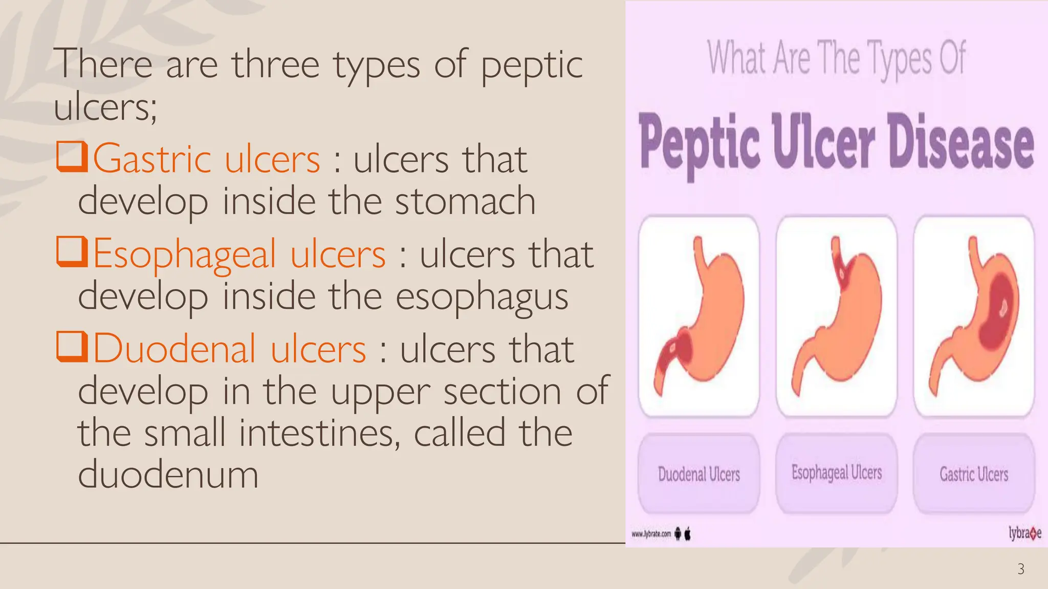 PEPTIC ULCER DISEASE,SLIDESHARE PRESENTATION | PDF