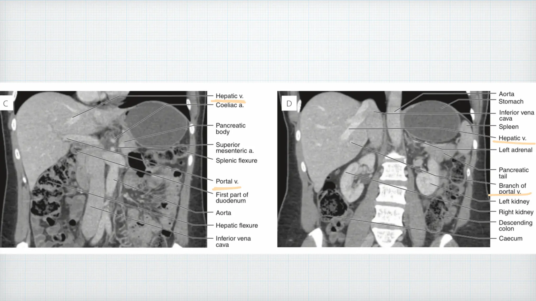 Power point presentation on Radiological anatomy of Liver | PDF ...