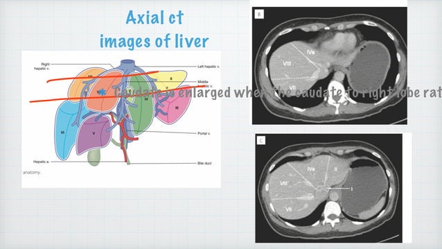 Power point presentation on Radiological anatomy of Liver | PDF ...