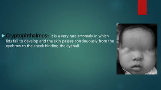 Disease of eyelid ,Anatomy and physiology of eyelid | PPTX