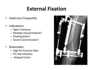 Flexible intramedullary nails with supplemental external fixator in ...