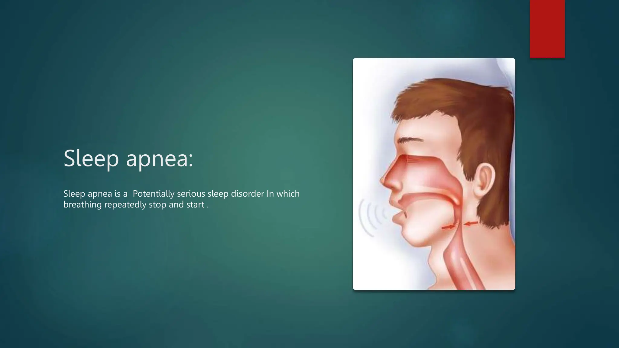 Obstructive sleep apnea (OSA) and Obesity hypoventilation syndrome (OHS ...