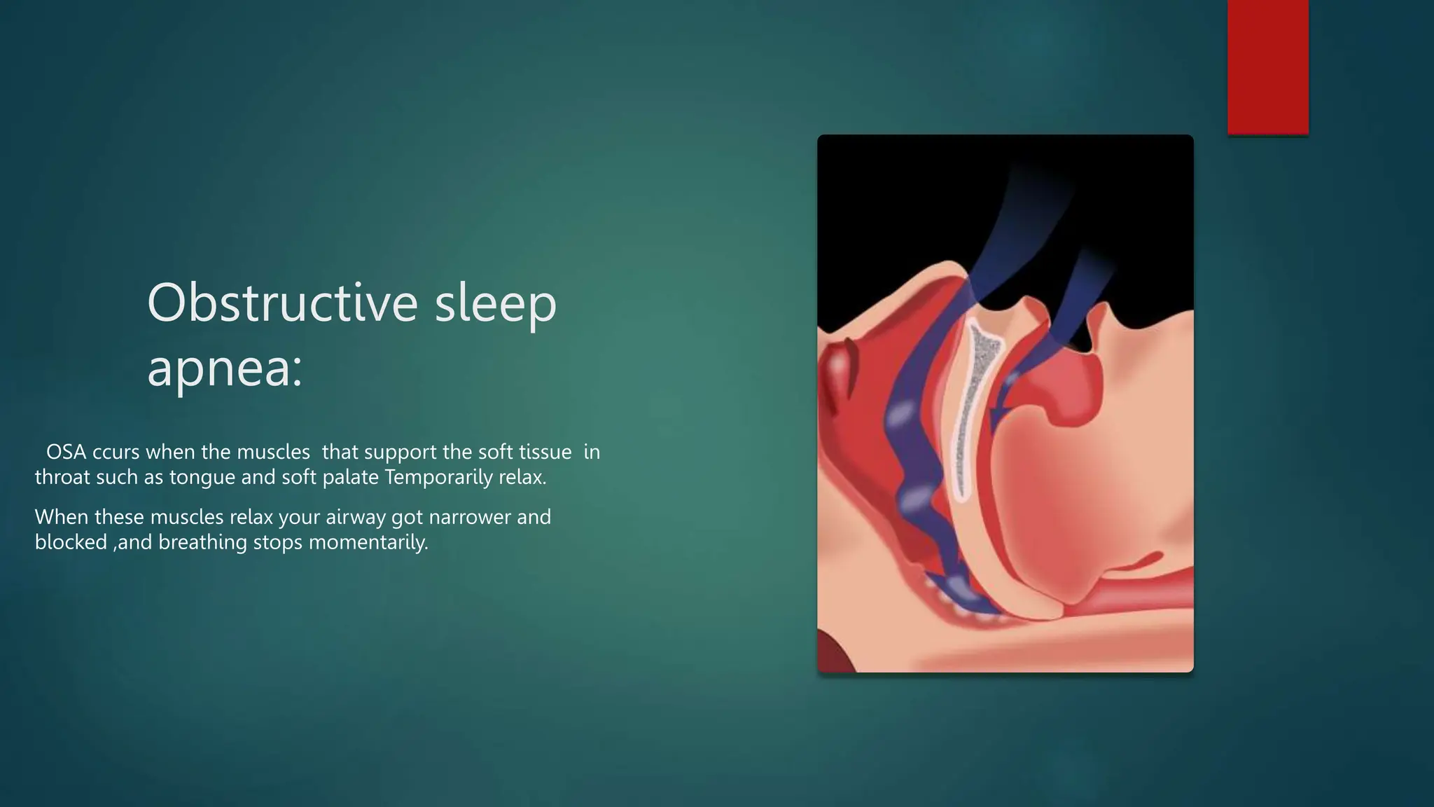 Obstructive sleep apnea (OSA) and Obesity hypoventilation syndrome (OHS) | PPTX