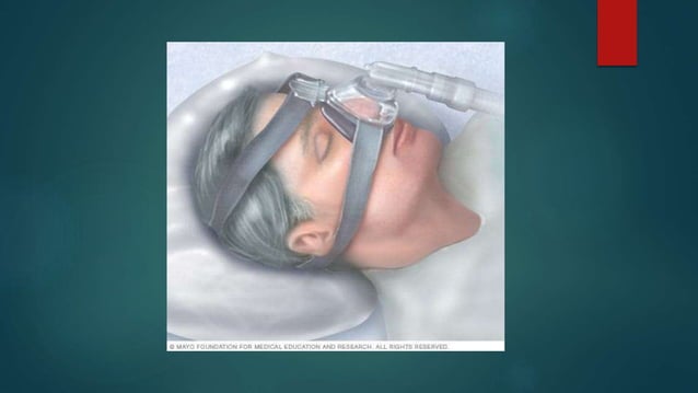 Obstructive sleep apnea (OSA) and Obesity hypoventilation syndrome (OHS ...