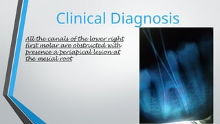 Presentation.pptx for endodontic cases of | PPTX