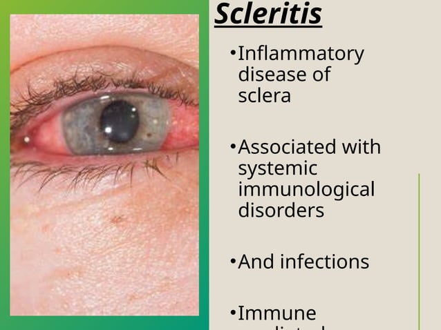 Scleritis Opthalmology 4th year MBBS.pptx