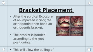Presentation for Biomechanics for impacted incisors | PPTX