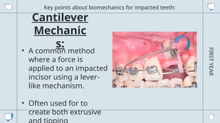 Presentation for Biomechanics for impacted incisors | PPT