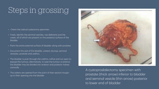 Urinarybladdergrosspathologytatahistopath.pdf
