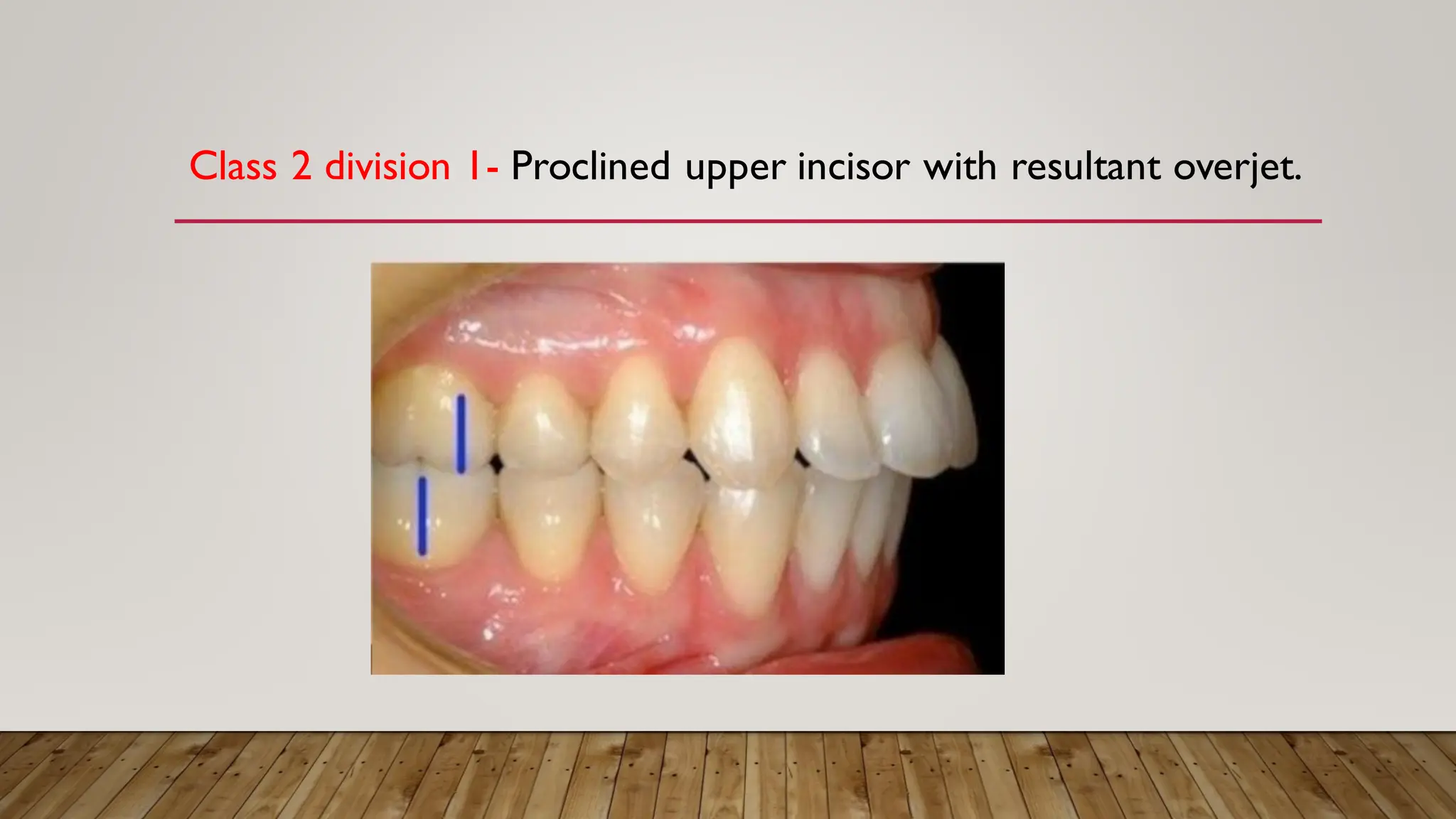 Classification of malocclusion various types of malocclusion | PDF