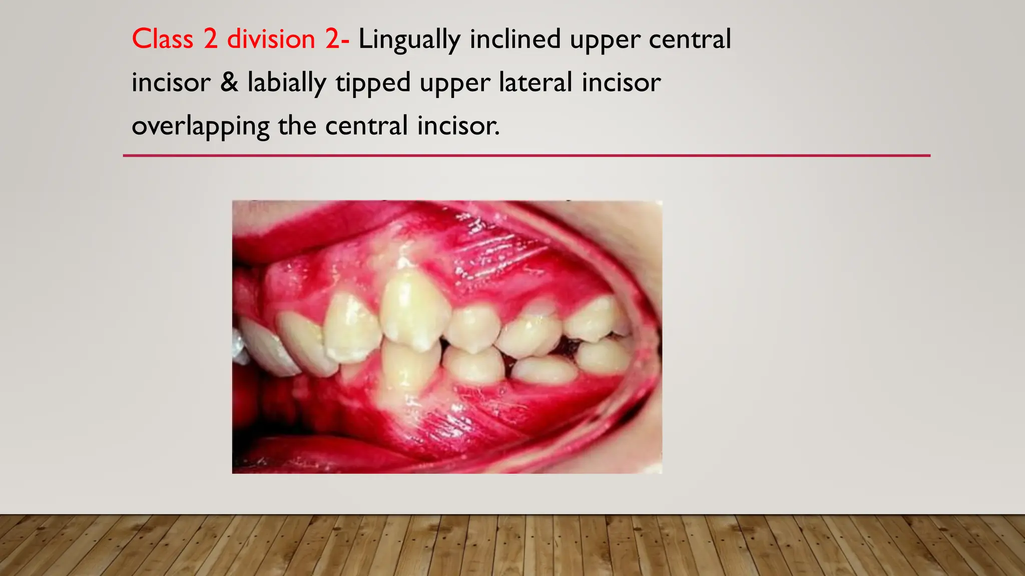 Classification of malocclusion various types of malocclusion | PDF