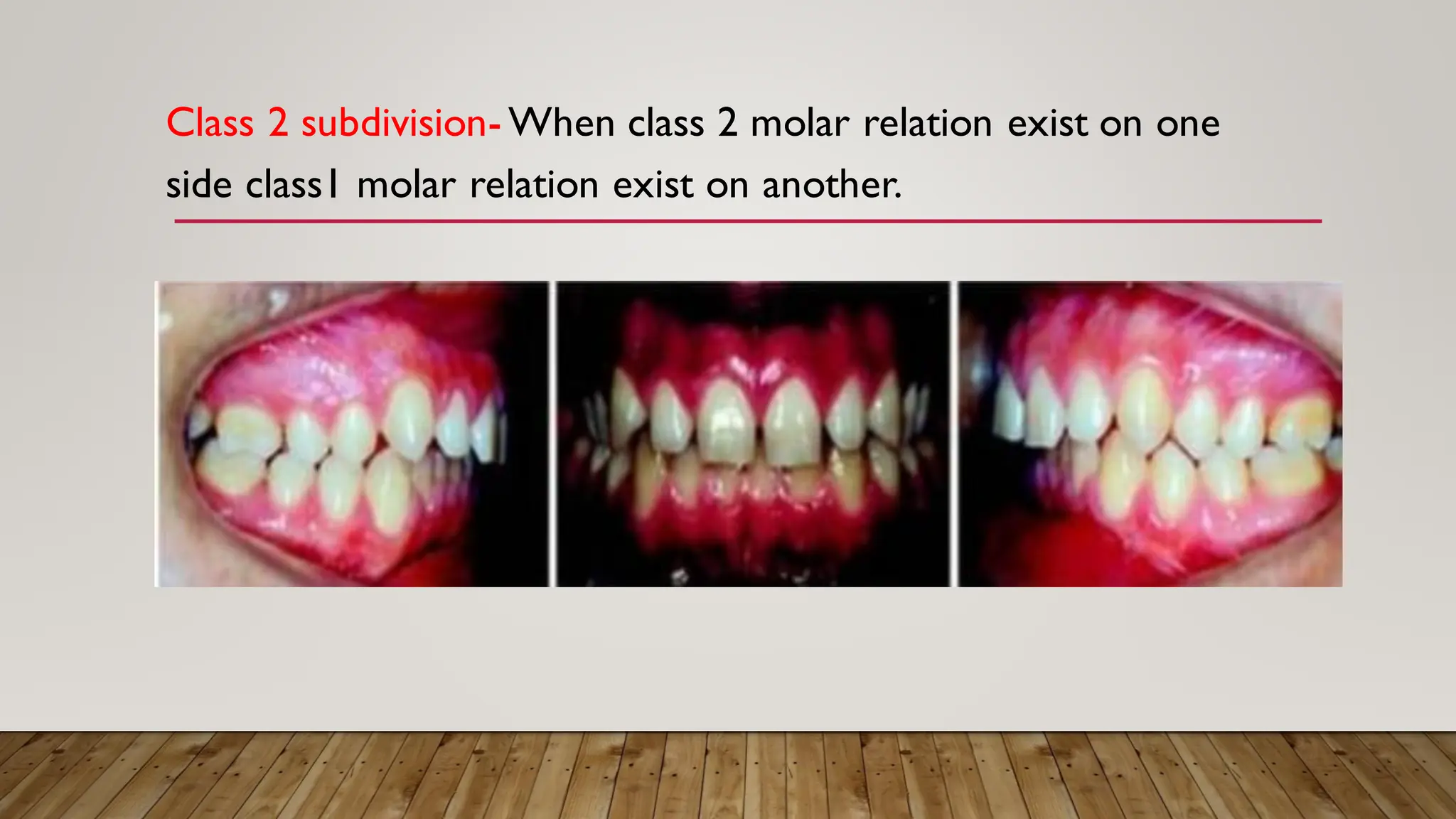 Classification of malocclusion various types of malocclusion | PDF