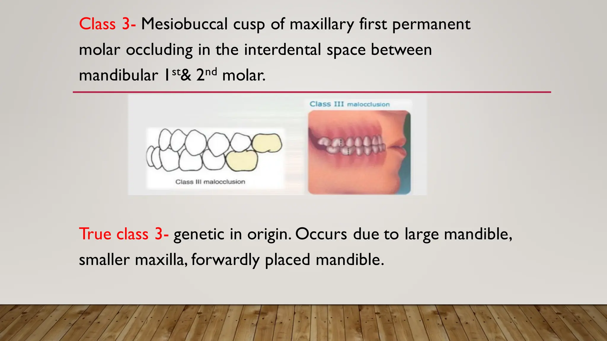 Classification of malocclusion various types of malocclusion | PDF
