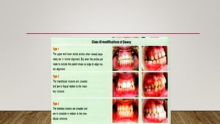 Classification of malocclusion various types of malocclusion | PDF