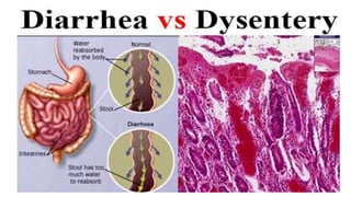 Presentation 4-dysentery | PPTX | Infectious Diseases | Diseases and Conditions