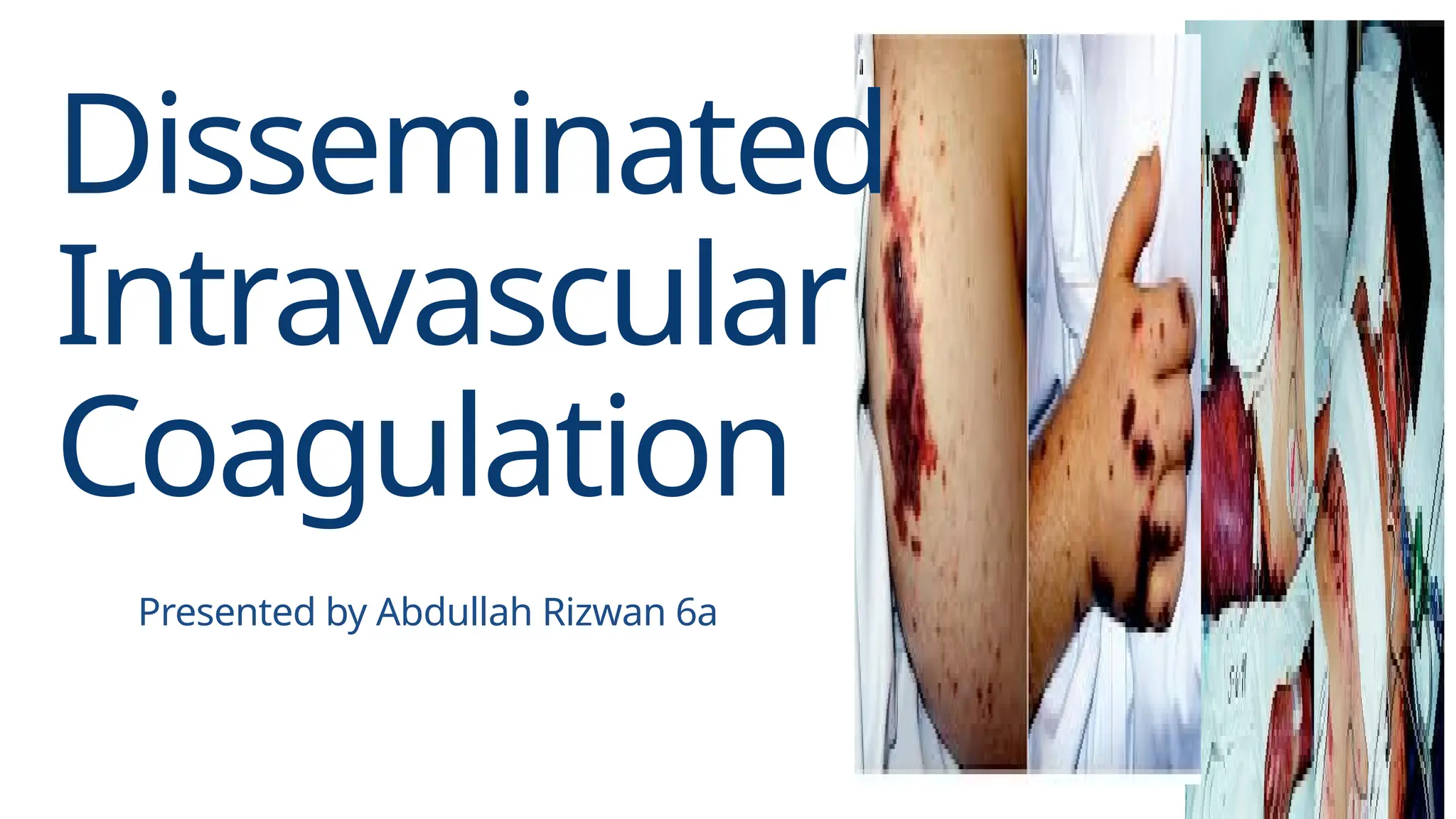 Presentation - Disseminated Intravascular Coagulation.pptx