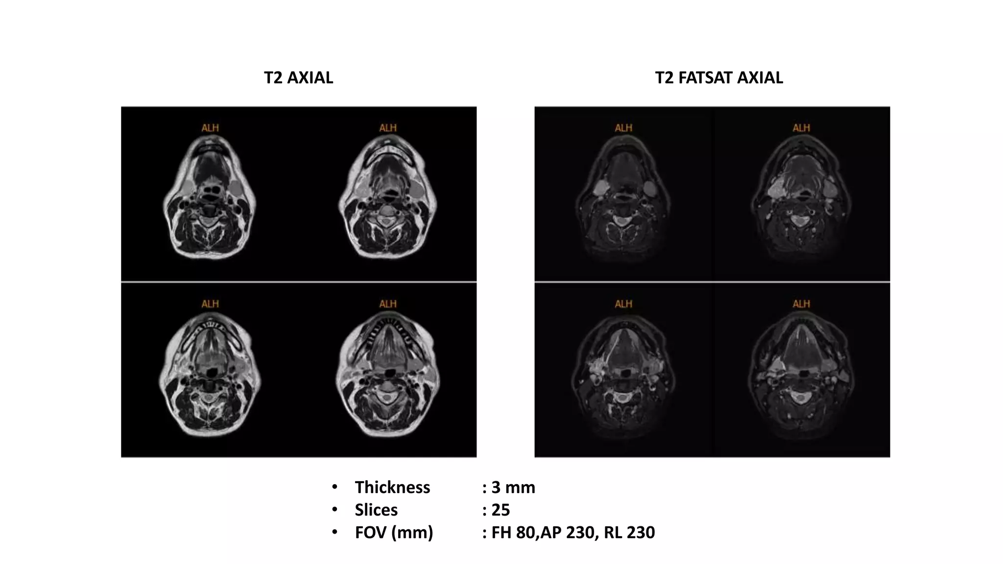 Teknik MRI Sialografi Kelenjar Submandibular pada Kasus Sialadenitis | PPTX