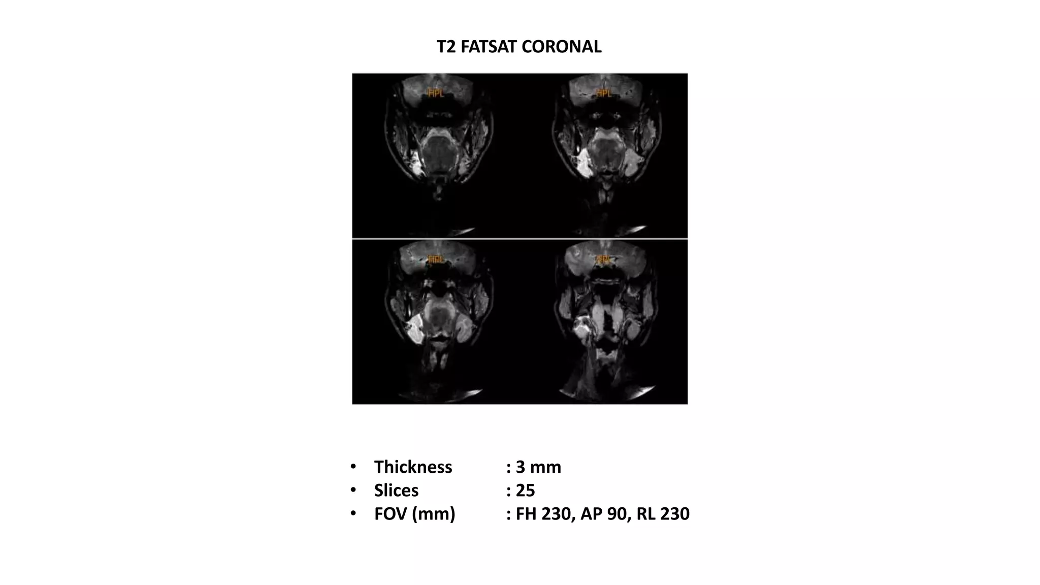 Teknik MRI Sialografi Kelenjar Submandibular pada Kasus Sialadenitis | PPTX