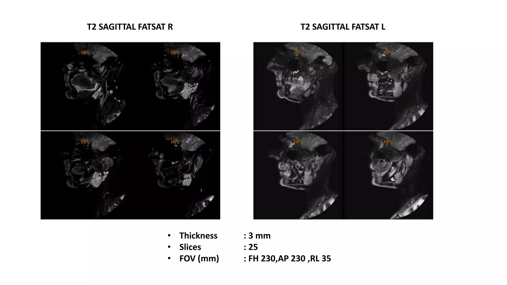 Teknik MRI Sialografi Kelenjar Submandibular pada Kasus Sialadenitis | PPTX