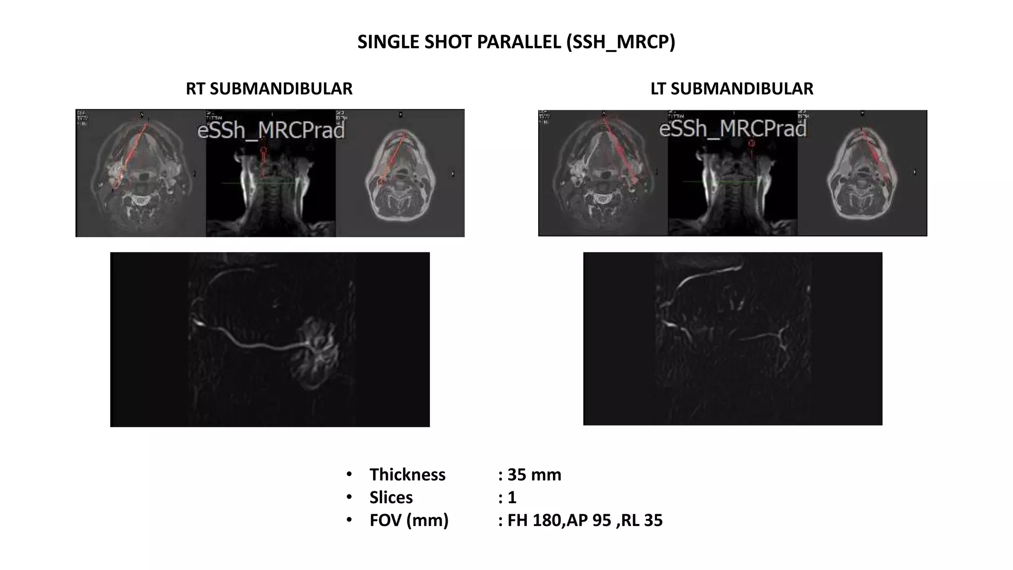 Teknik MRI Sialografi Kelenjar Submandibular pada Kasus Sialadenitis | PPTX