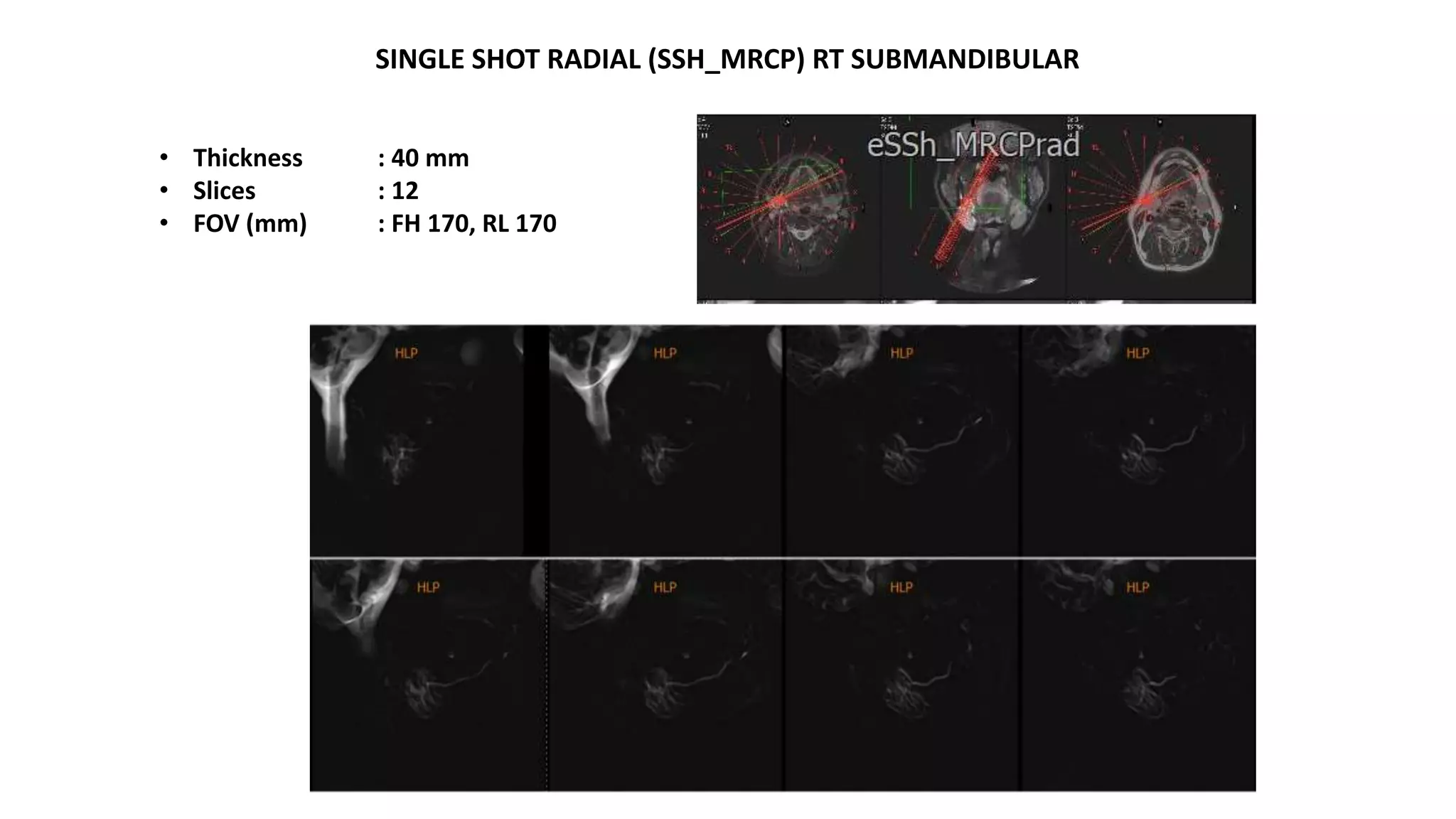 Teknik MRI Sialografi Kelenjar Submandibular pada Kasus Sialadenitis | PPTX
