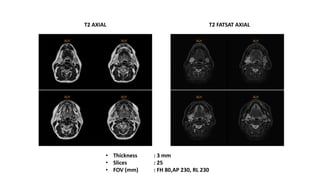 Teknik MRI Sialografi Kelenjar Submandibular pada Kasus Sialadenitis | PPT
