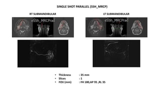 Teknik MRI Sialografi Kelenjar Submandibular pada Kasus Sialadenitis | PPT