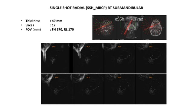 Teknik MRI Sialografi Kelenjar Submandibular pada Kasus Sialadenitis | PPT
