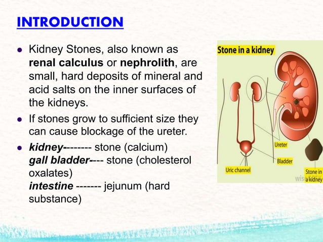 Presentation kidney-stone final | PPTX