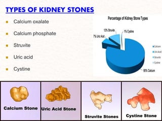 Presentation kidney-stone final | PPTX