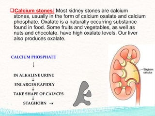 Presentation kidney-stone final | PPTX
