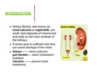 presentation-kidney-stonefinal.pptx