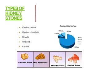 presentation-kidney-stonefinal.pptx