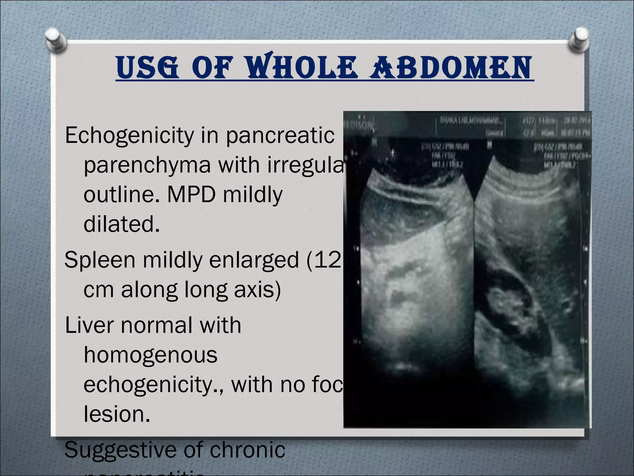 Case presentation: Chronic pancreatitis | PPT