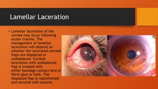 Presentation - Ocular Trauma.- injury to eye | PPTX