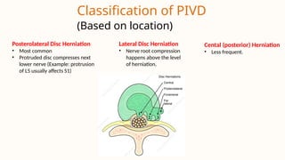 PIVD & Lumbar spinal stenosis,Orthopaedics | PPTX