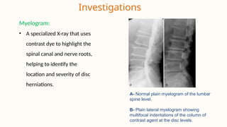 PIVD & Lumbar spinal stenosis,Orthopaedics | PPTX