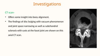PIVD & Lumbar spinal stenosis,Orthopaedics | PPTX