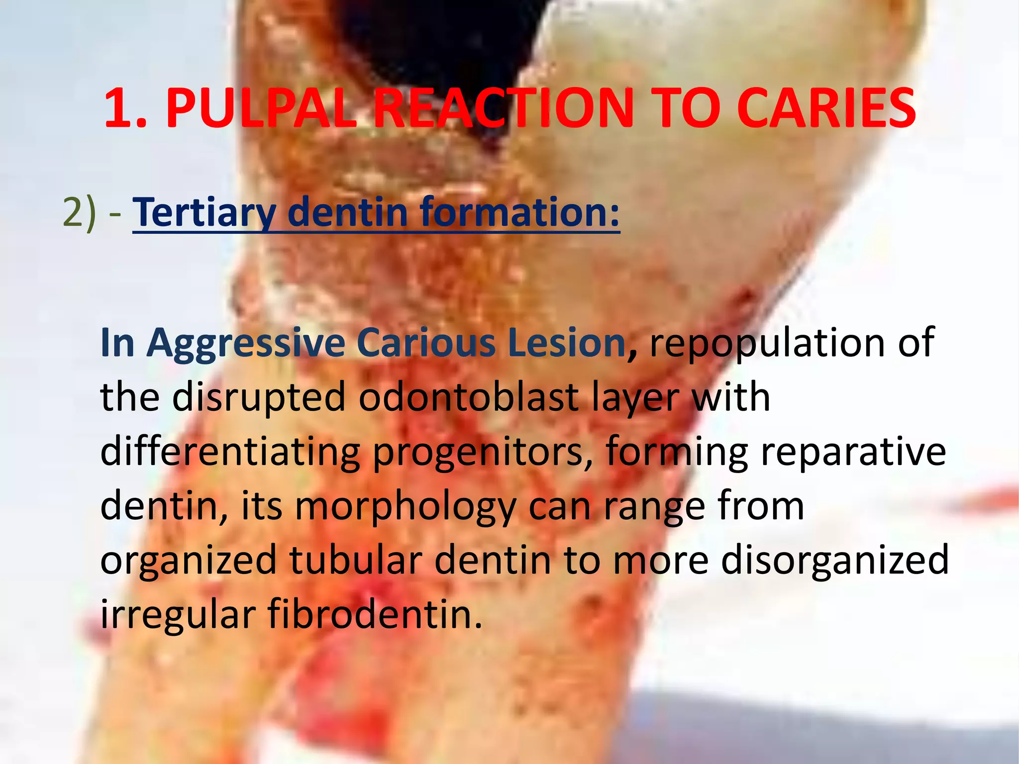 Pulpal Reactions to Dental Caries and Dental Proceudres | PPTX