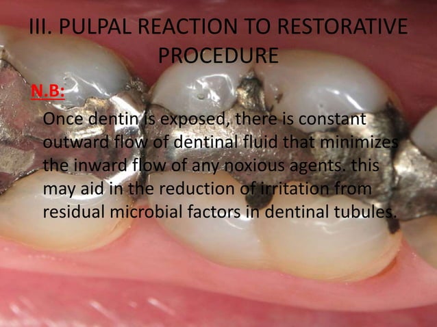 Pulpal Reactions to Dental Caries and Dental Proceudres | PPTX | Dental ...