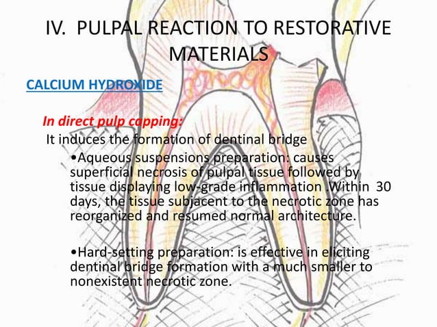 Pulpal Reactions to Dental Caries and Dental Proceudres | PPTX | Dental ...