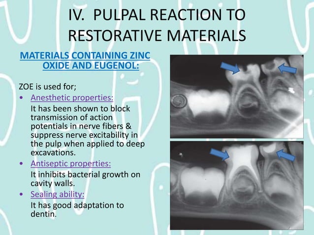 Pulpal Reactions to Dental Caries and Dental Proceudres | PPTX | Dental ...