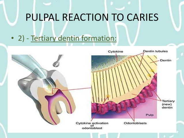 Pulpal Reactions to Dental Caries and Dental Proceudres | PPTX | Dental ...