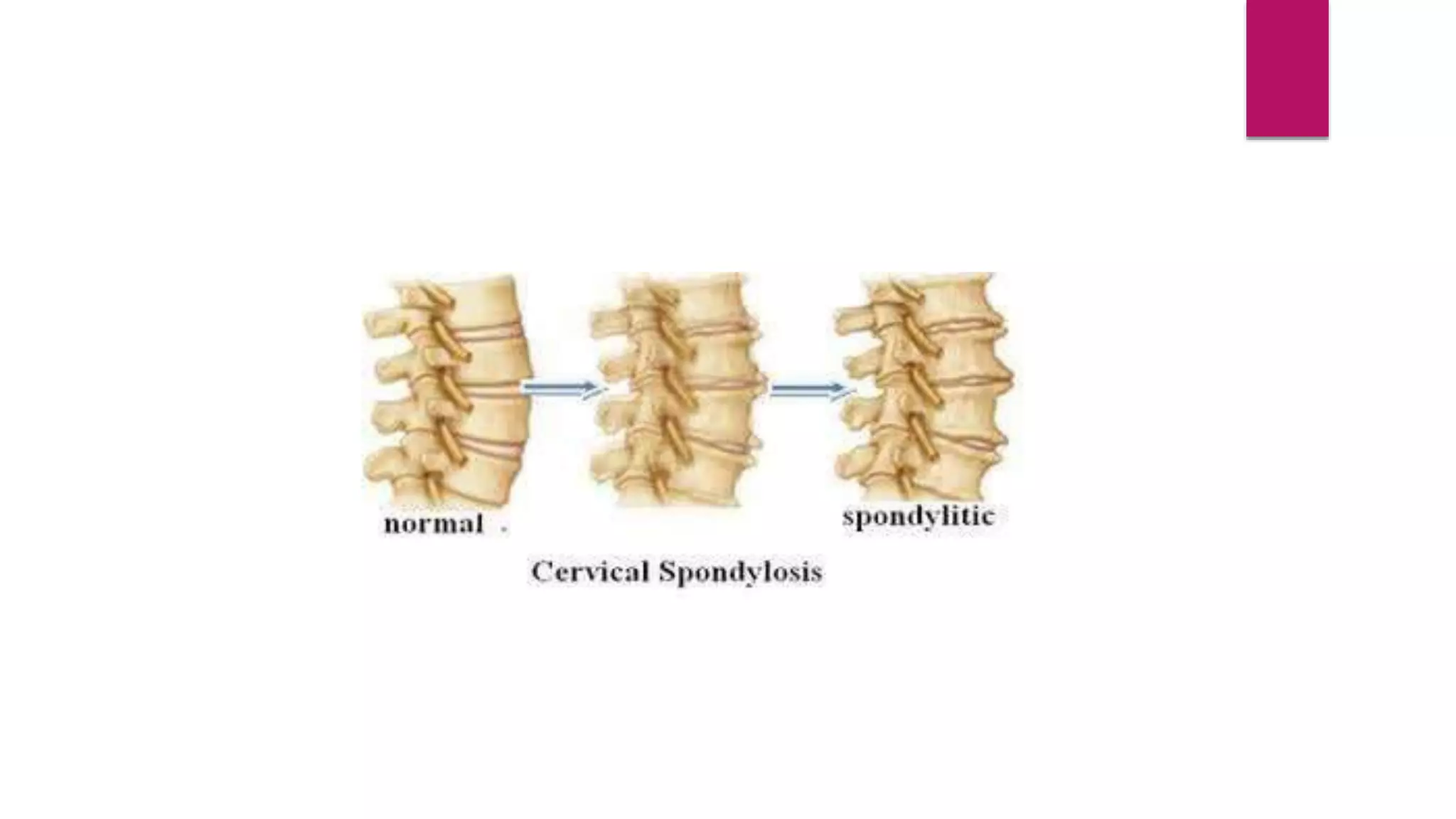 Cervical spondylitis & spondylosis by Dr.Bhavin | PPTX